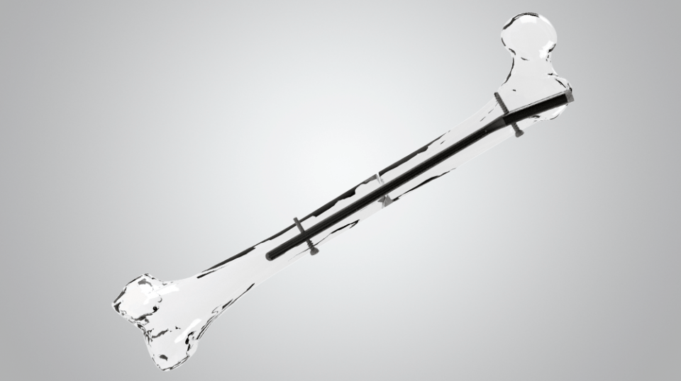 Agile Nail - Orthofix