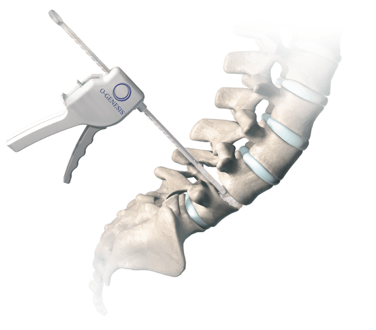 O-Genesis - Orthofix