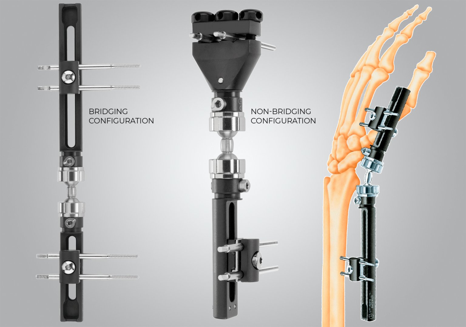Pennig Dynamic Wrist Fixator - Orthofix