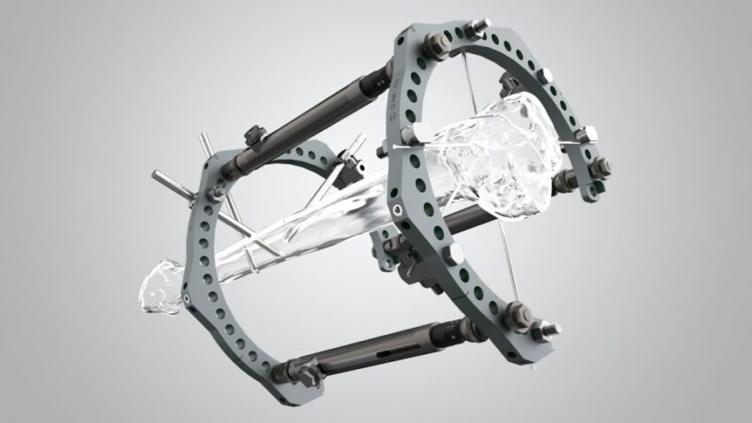 TL-HEX TrueLok Hexapod System - Orthofix