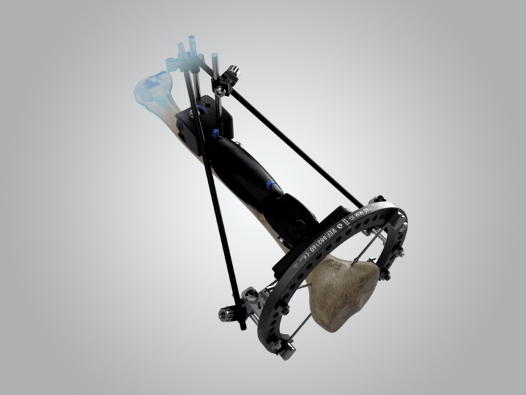 XCaliber Hybrid Fixation - Orthofix