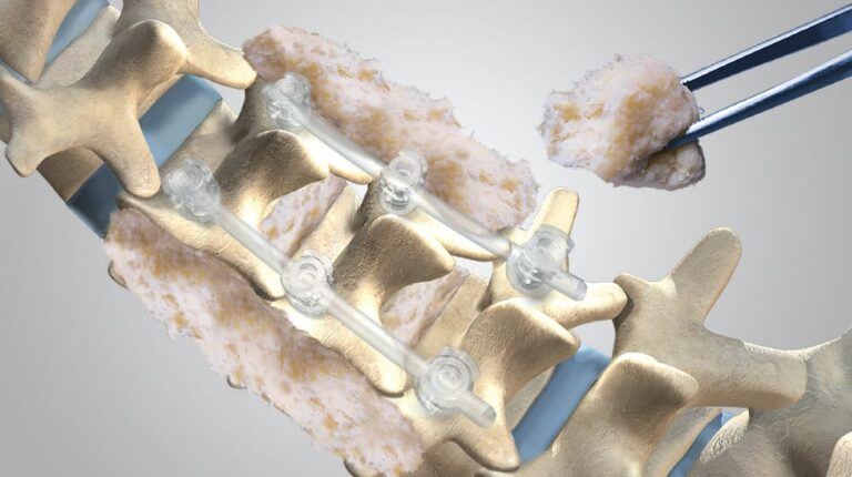 New Clinical Studies Reinforce Trinity Elite's Efficacy in Bone Fusion ...
