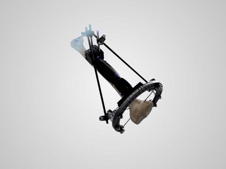 XCaliber Hybrid Fixation - Orthofix