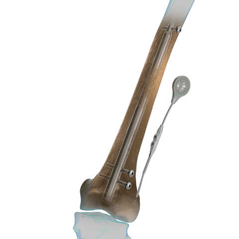 Orthofix Announces More Than 5,000 Fitbone Intramedullary Limb ...