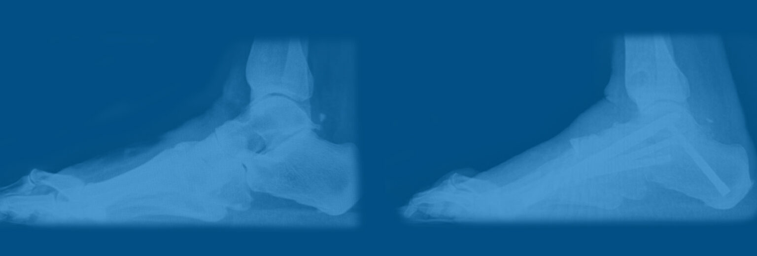 Unveiling the Science: How Charcot Foot Surgical Reconstruction Works ...