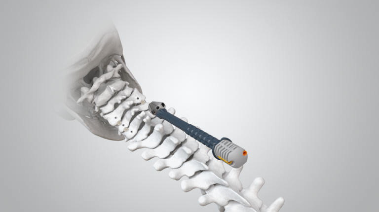 IsoTis Cervical Facet Fusion - Orthofix