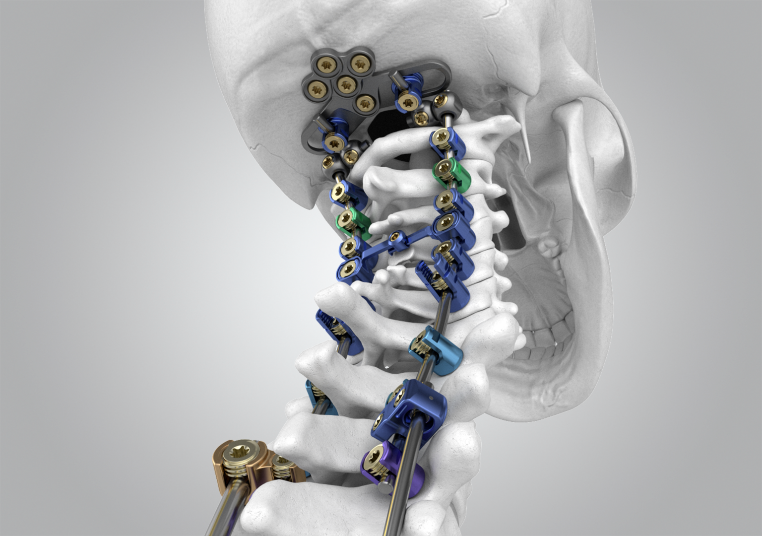 NorthStar OCT - Orthofix