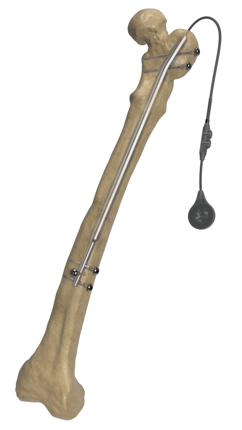 Orthofix Announces 510(k) Clearance and First Implant of Fitbone ...