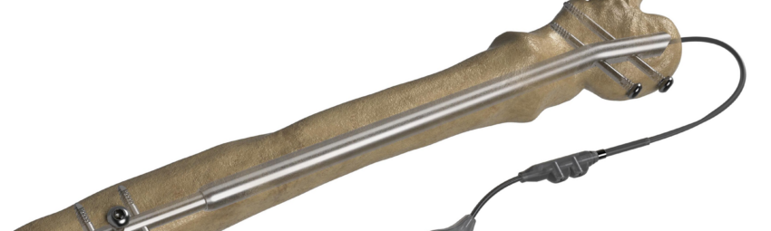 Orthofix Announces 510(k) Clearance and First Implant of Fitbone ...