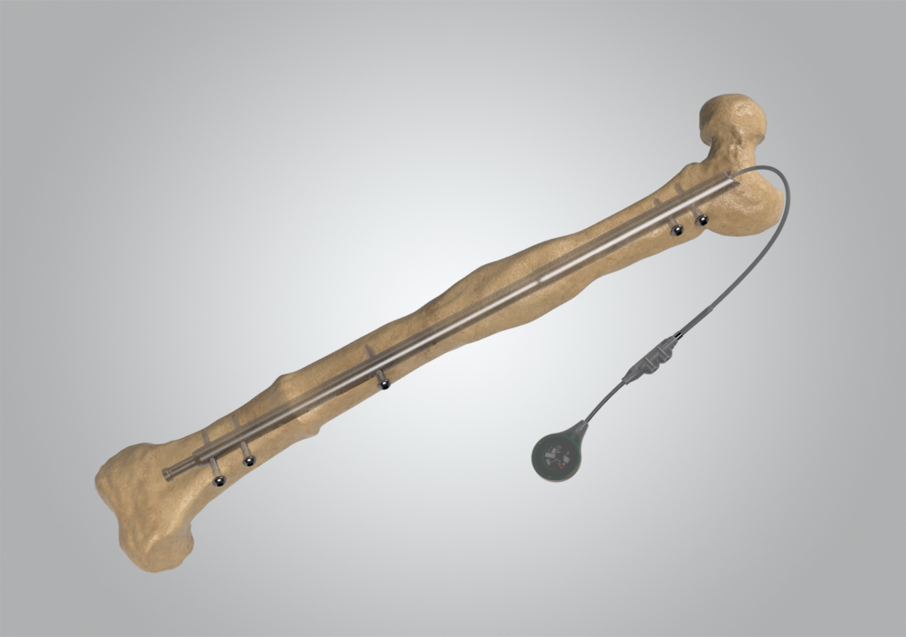 Fitbone Transport and Lengthening System - Orthofix