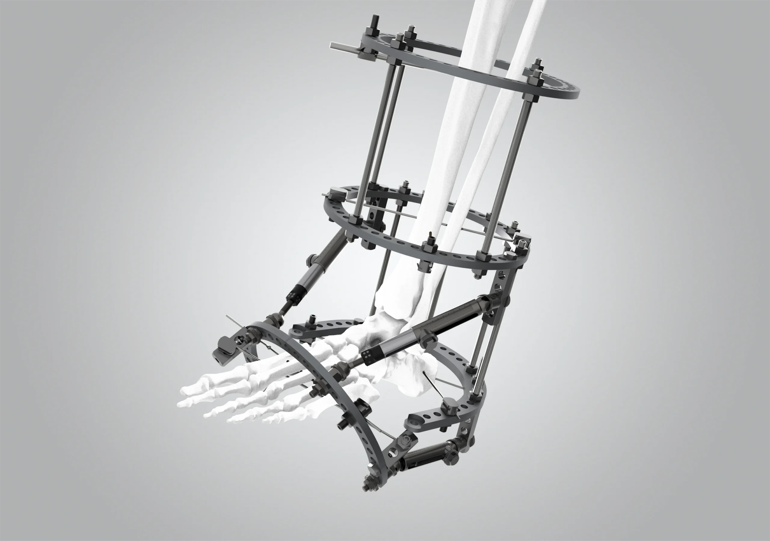 Extremity Deformity Correction - Orthofix