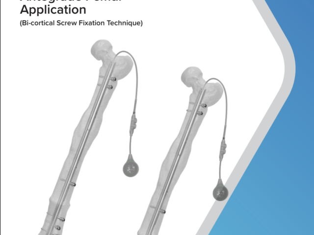 Fitbone Transport and Lengthening System - Orthofix