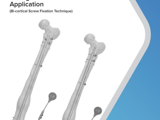 Fitbone Transport and Lengthening System - Orthofix