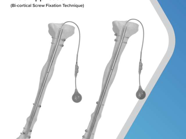 Fitbone Transport and Lengthening System - Orthofix