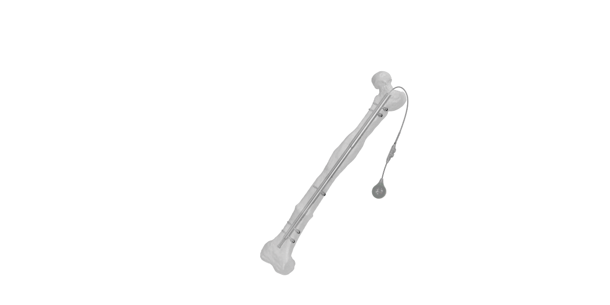 Orthofix Announces US Commercial Launch of the Fitbone Transport and Lengthening System - Orthofix